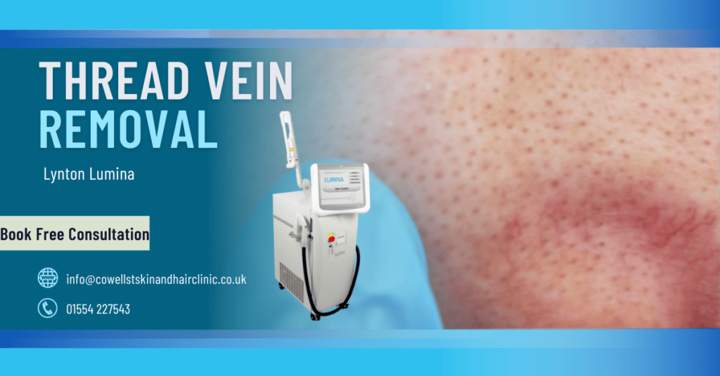 Thread vein removal - test