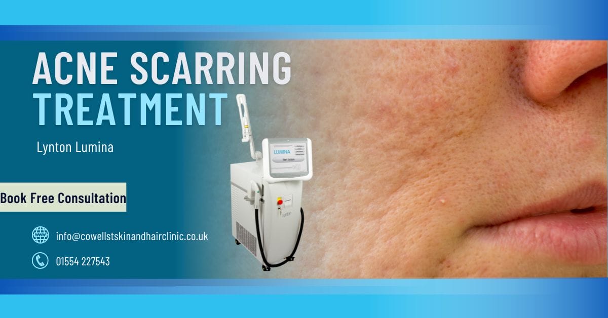 Acne scar - test