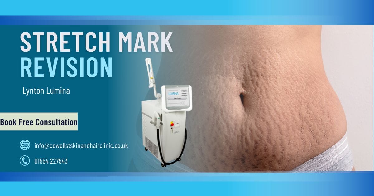 Stretch Marks - test